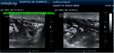 Fascitis necrotizante, caso clínico | Kubatz La Madrid | Correo ...