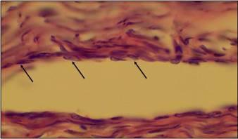 Características morfométricas del epitelio endometrial en pacientes con ...